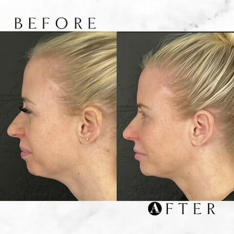 Filler migration and dissolving fillers: Understanding and managing the ...