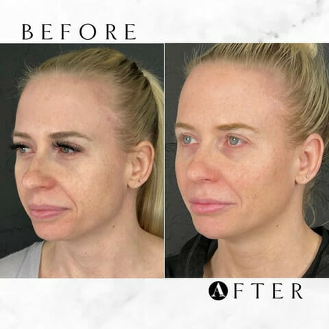 Filler migration and dissolving fillers: Understanding and managing the ...